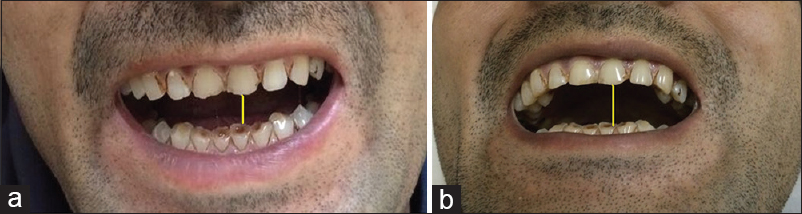 Best Oral Cancer Treatment in Udaipur, Best Dentist for Oral Cancer and ...
